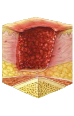 Pressure ulcer categories - careofsweden
